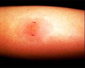 MY OPEN BOOK: PPD Test and the BCG vaccine