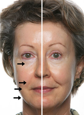 Esteliq: Aging, Sagging and Photoaged Skin