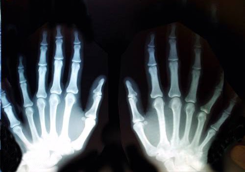 A Baby Is Born With 6 Fingers And Six Toes - Echoes Of The Nephilim?