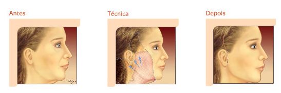 BELVIVERE CIRURGIA PLÁSTICA E LASER: CIRURGIA DE FACE - (Facelift)