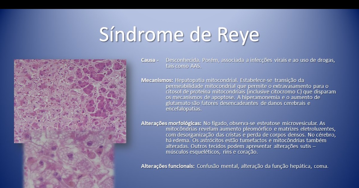 Rapidinhas Patológicas: Síndrome de Reye