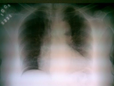 Radiologia, física e concurso - RJ: Pneumoperitônio no PA de tórax