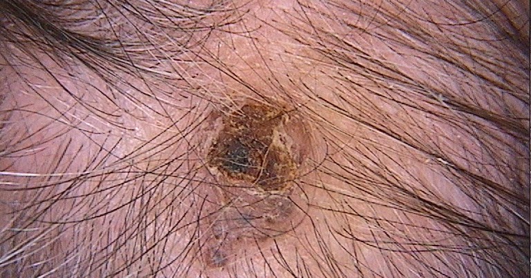 DERMOSCOPIA: BASALIOMA?