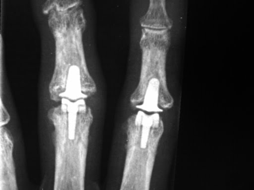 Daily Dose: PIPJ replacements