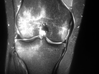 Daily Dose: ACL tear