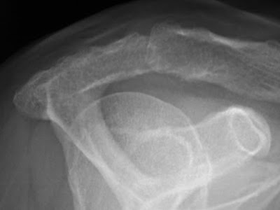 Daily Dose: Type 2 acromion