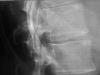 Daily Dose: Romanus lesion of ankylosing spondylitis