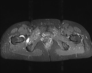 Daily Dose: Obturator externus bursitis