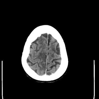 Daily Dose: A rare case of bilateral ACA infarct