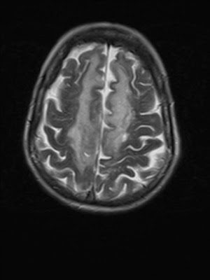 Daily Dose: A rare case of bilateral ACA infarct