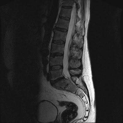 Daily Dose: Sacral metastasis