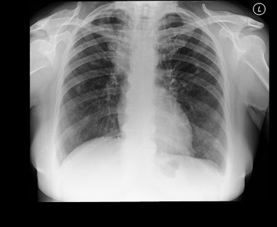 Daily Dose: Right upper lobe collapse