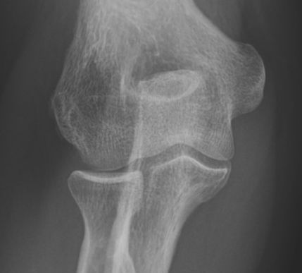 Daily Dose: Lateral epicondylitis