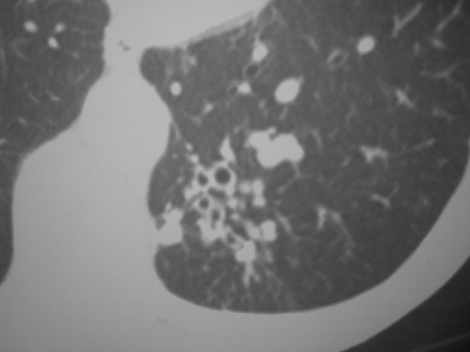Daily Dose: Bronchiectasis in tuberculosis