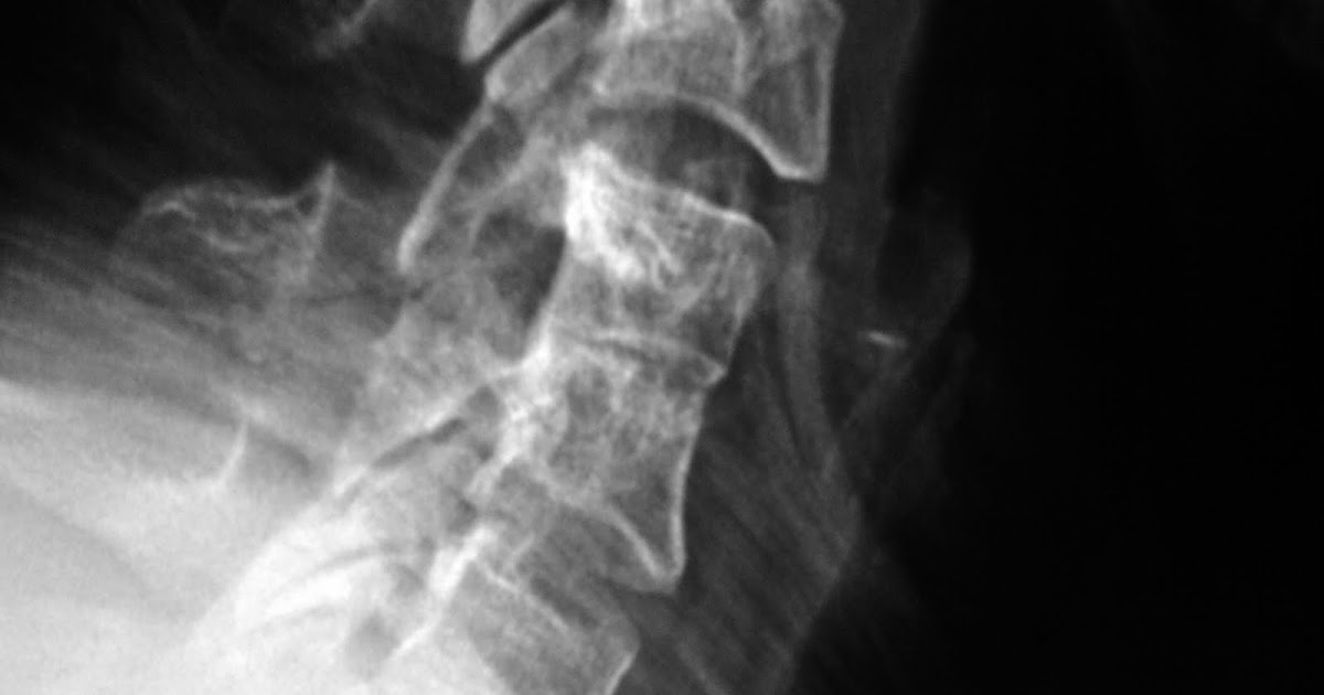 Daily Dose: Congenital block vertebra