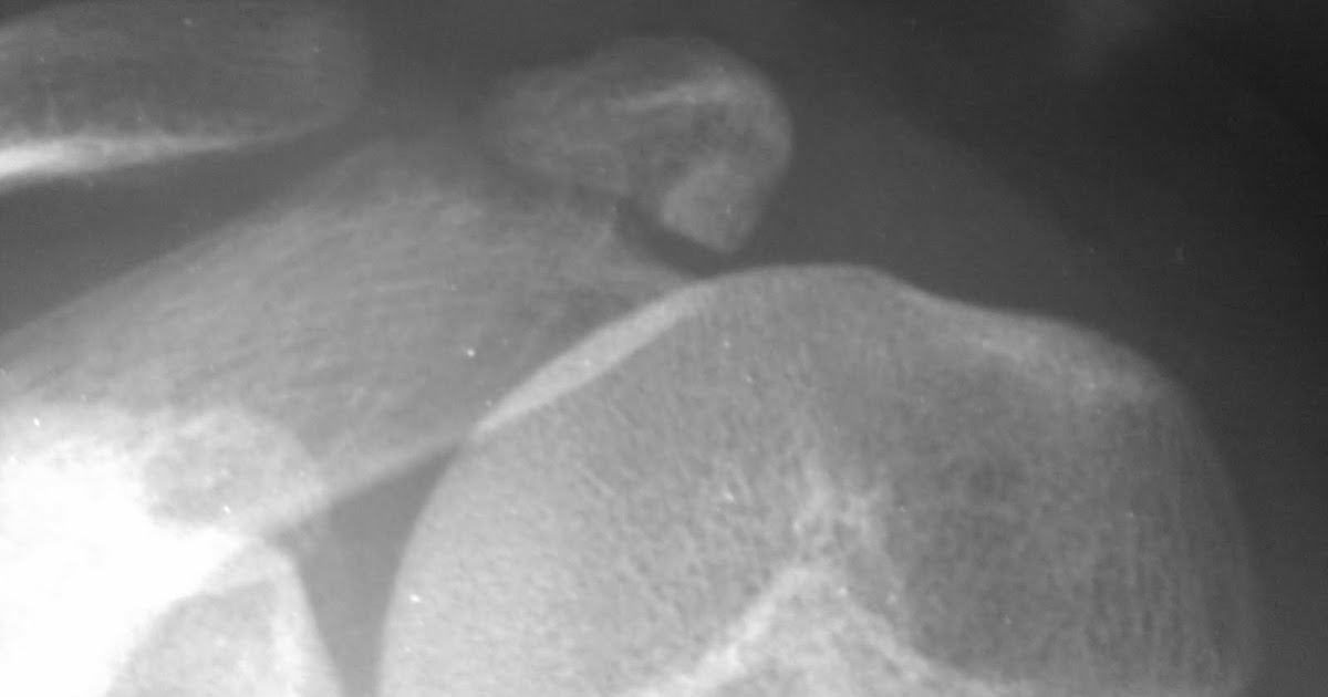 Daily Dose: Acromial ossification centre