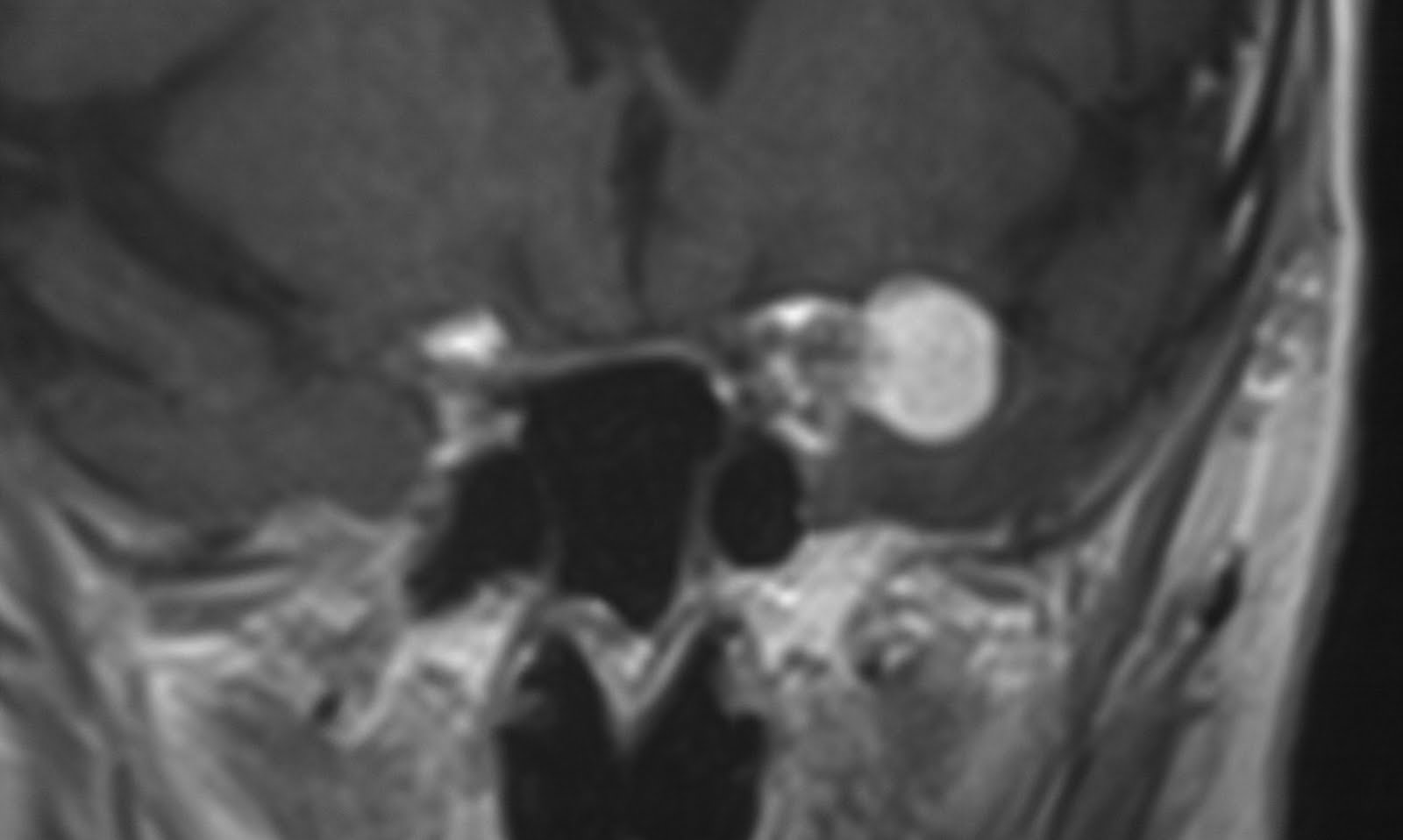 Daily Dose Sphenoid Wing Meningioma