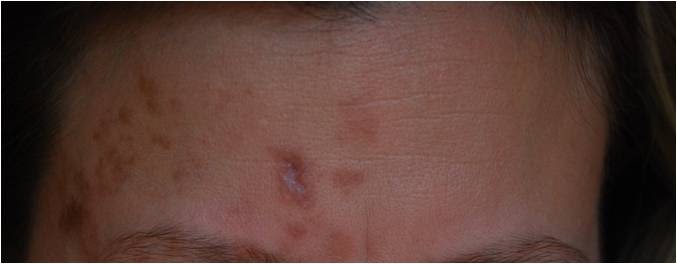 Bluestem: What do shingles scars look like one month after they erupt?
