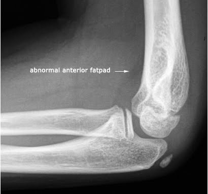 Case-a-día: Radial Head Fracture in the Adult