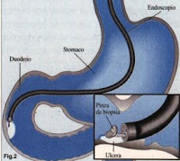 Pocket Study: ESOFAGOGASTRODUODENOSCOPIA
