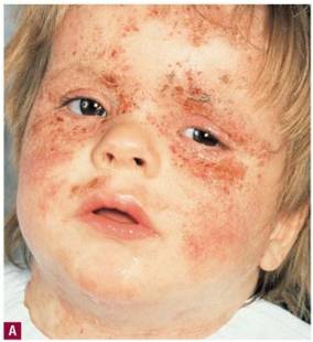 DIFFERENTIALS: "Itchy red" A case of severe atopic dermatitis ...