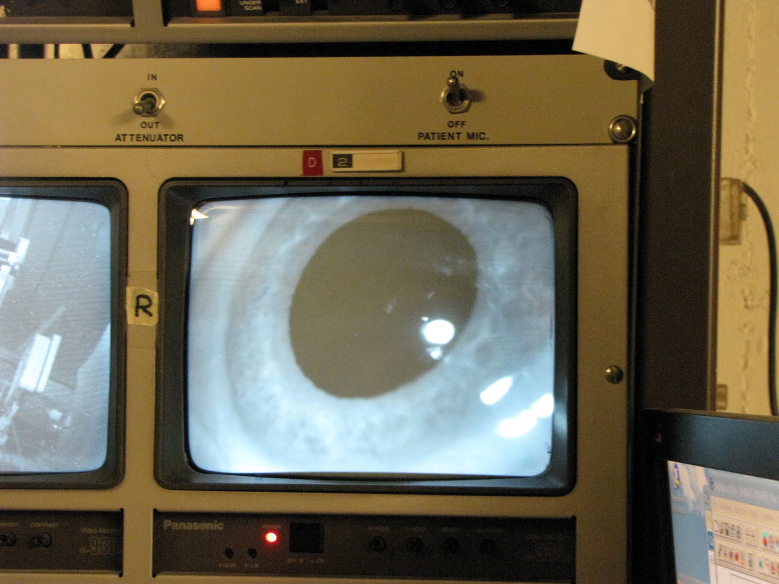 Big Trouble in Little Eyeball: 1st treatment