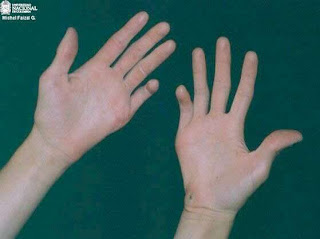 patologia-L.I.M.Di.C: Lesiones de los nervios del plexo braquial