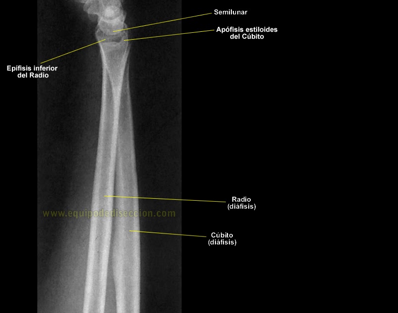 rx: Rx Lateral antebrazo