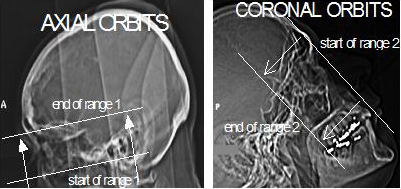 block note: Pemeriksaan CT Scan Orbita