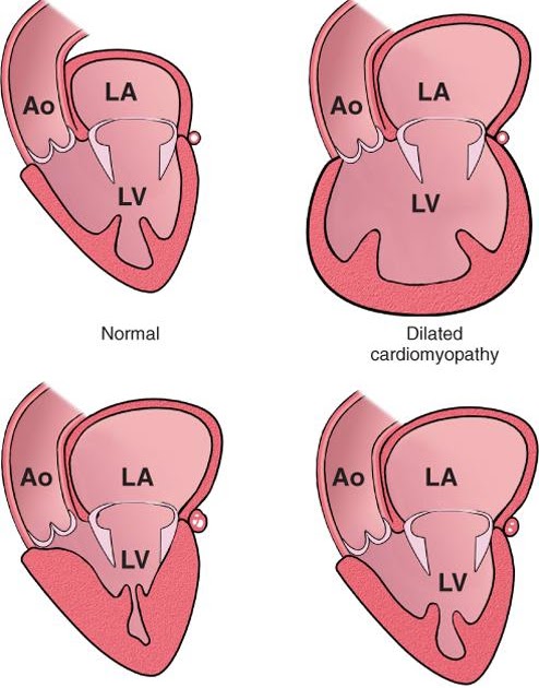 Cardiology Database: Pathology of cardiomyopathy