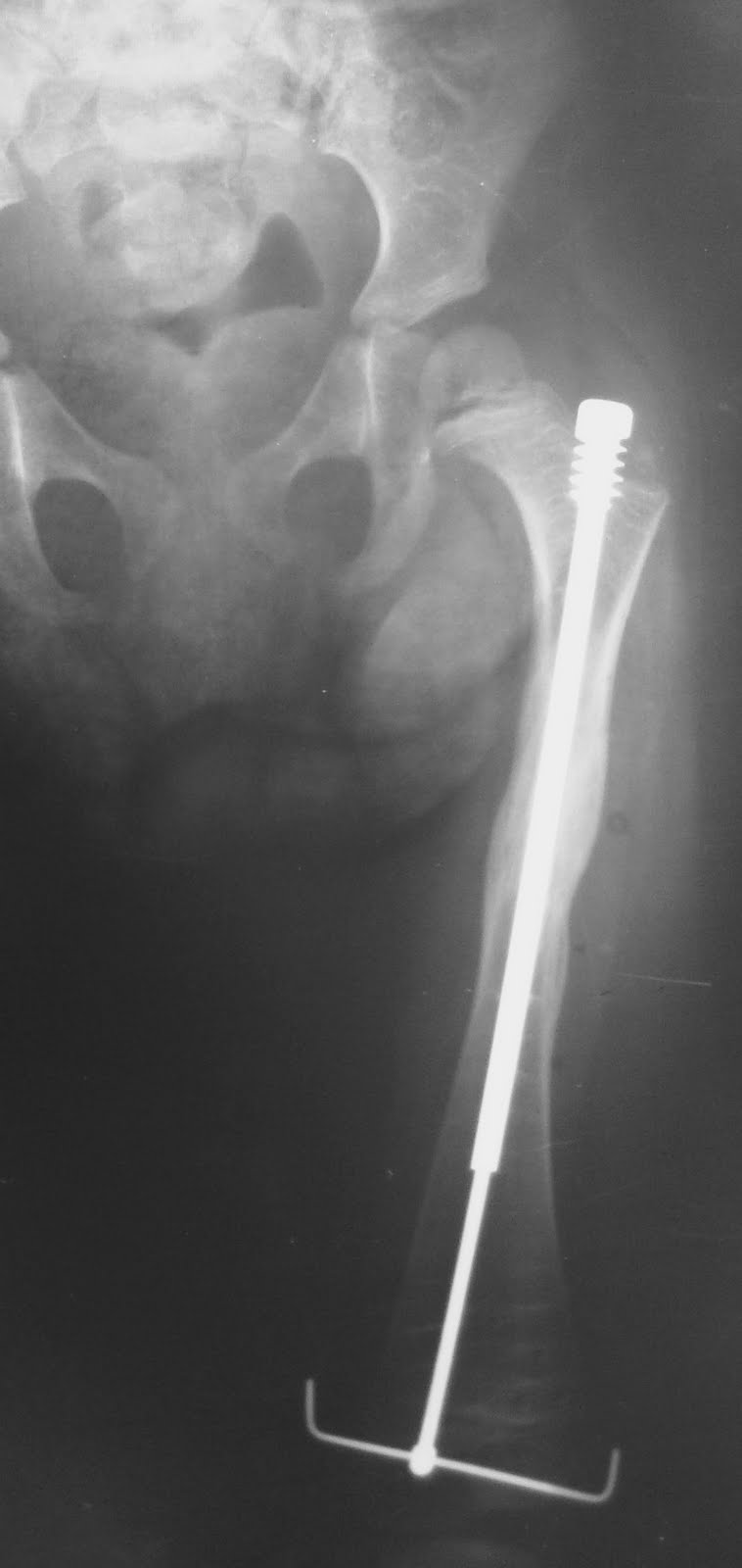 DR. CELSO RIZZI: Avaliação inicial do uso das Hastes Telescópicas ...
