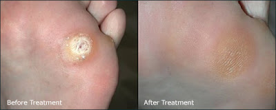 TREAT WITH THE WHOLE-HEARTED: skin; verruca 3 aetiology, histopatology ...