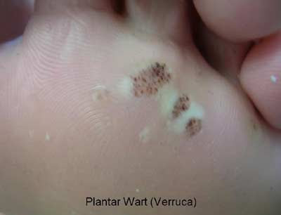 TREAT WITH THE WHOLE-HEARTED: skin; verruca 8 destructive therapy