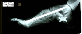 FOOT AND ANKLE PROBLEMS: ADULT ACQUIRED FLAT FOOT (PES PLANUS) - DR ...