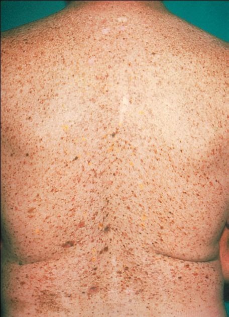 Xeroderma Pigmentosum Pictures Symptoms Treatment And More