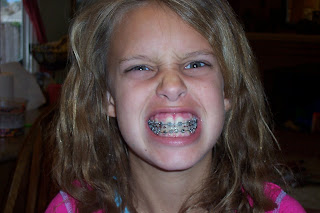Emily Gatchell: I NOW HAVE BRACES!!!