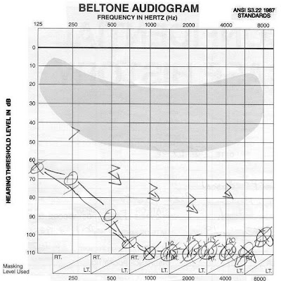 A deaf dude's life: All my audiograms thus far with my comments on them!