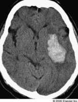 Nurse Central: Head Bleeds