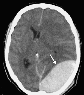 Nurse Central: Head Bleeds