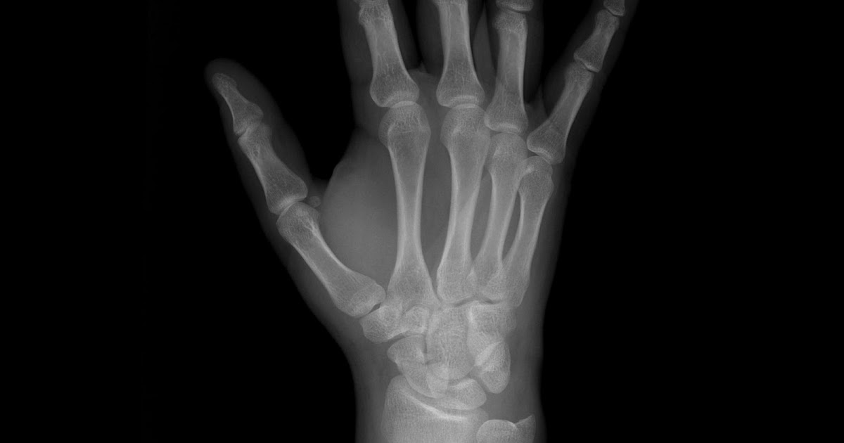 Triquetral Fracture Fracture Treatment
