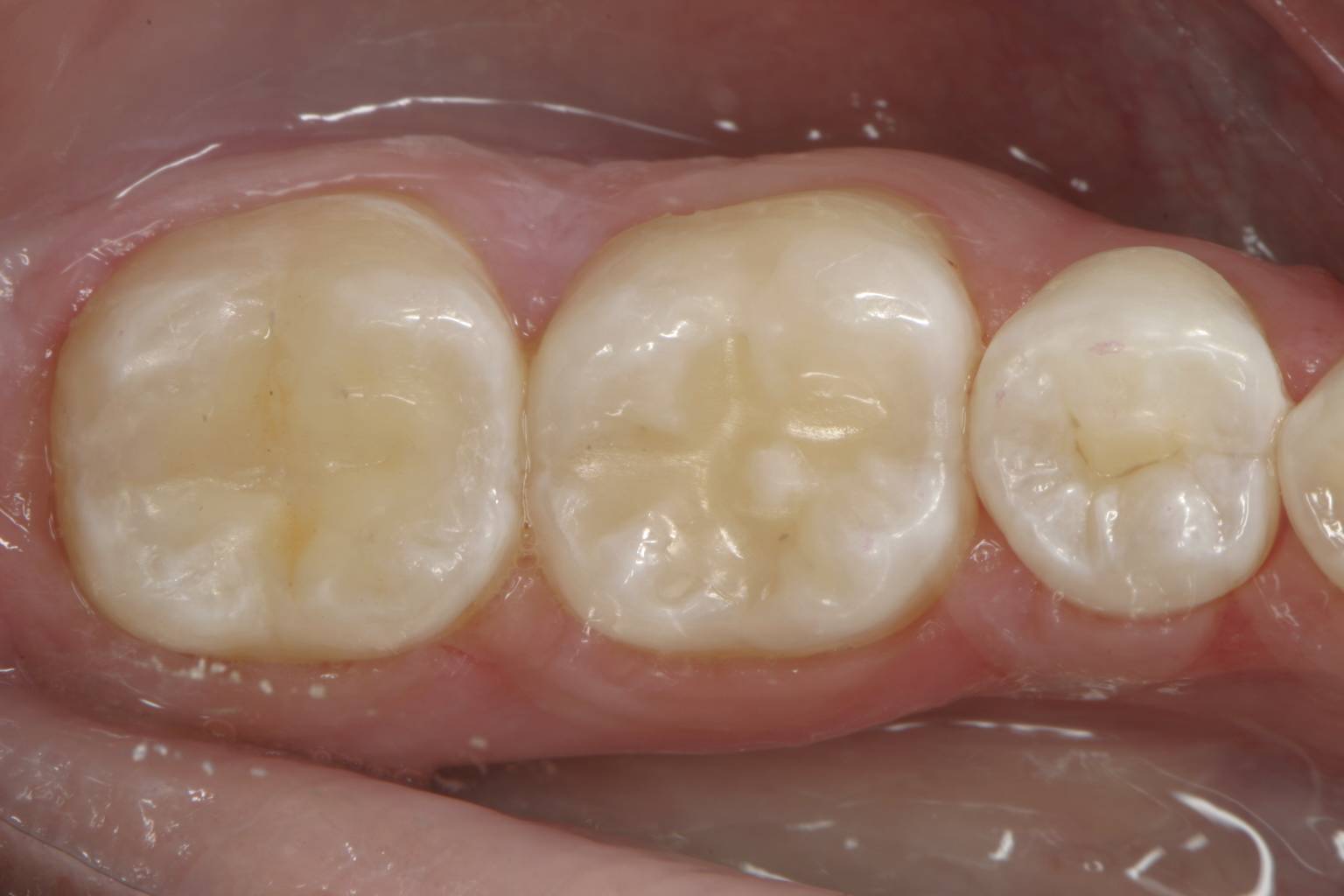 Ritter & Ramsey - General and Cosmetic Dentistry: Empress Direct ...