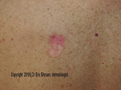 dermoscopy: Thin arborizing vessels