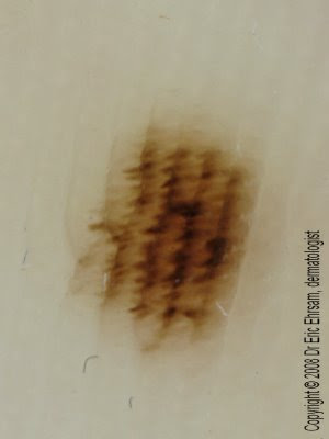 dermoscopy: September 2008