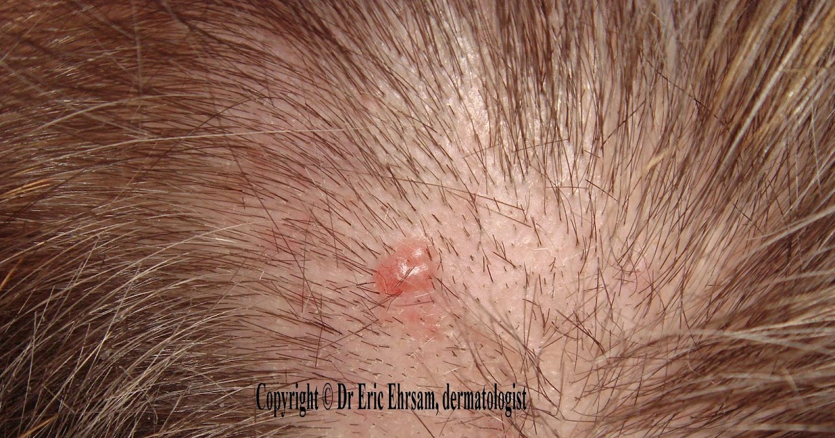 dermoscopy: Arborizing tree vessels