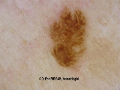 dermoscopy: Fat fingers