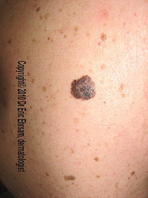 dermoscopy: Lost among black benign lesions....