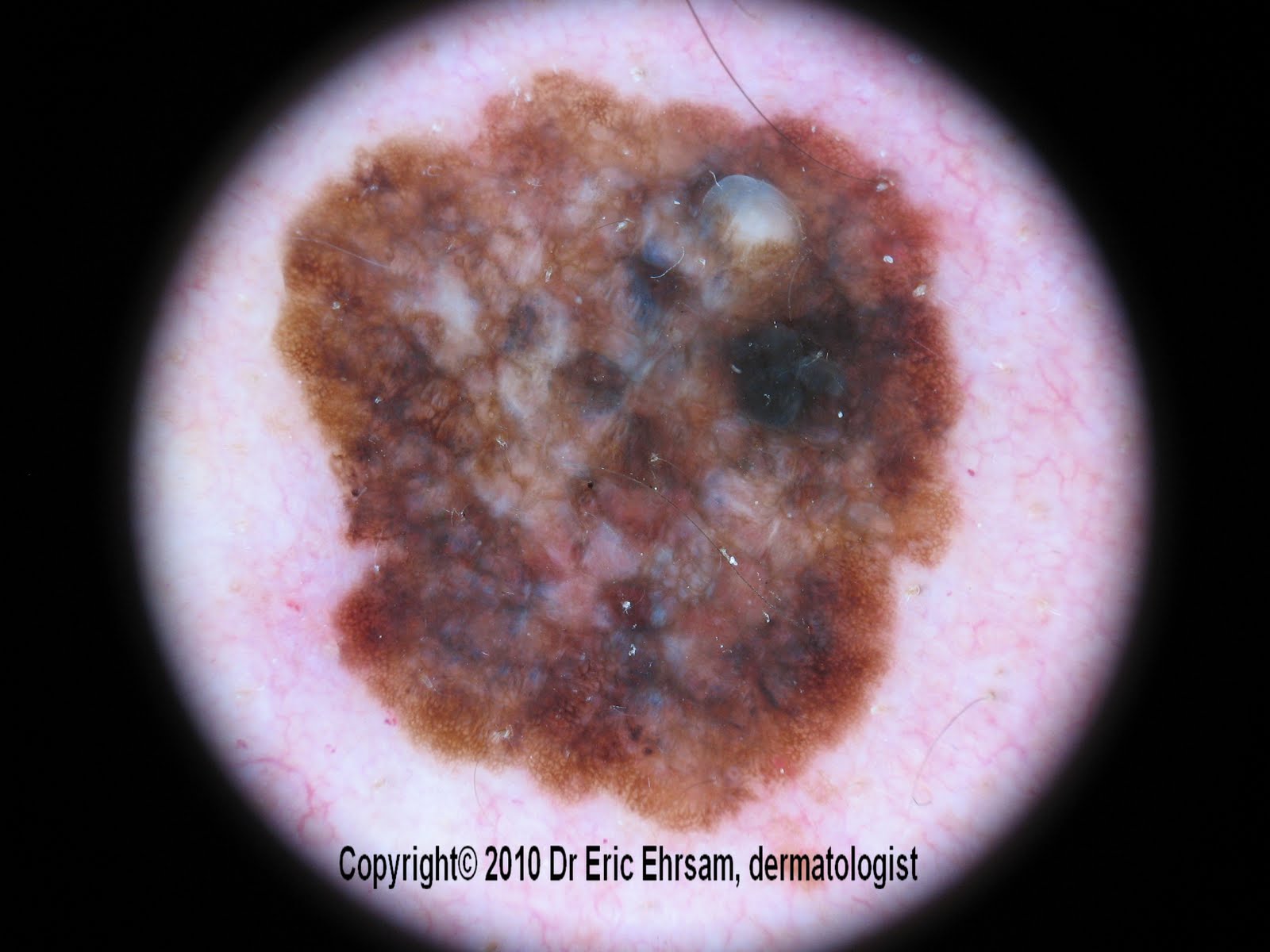 dermoscopy: Lost among black benign lesions....