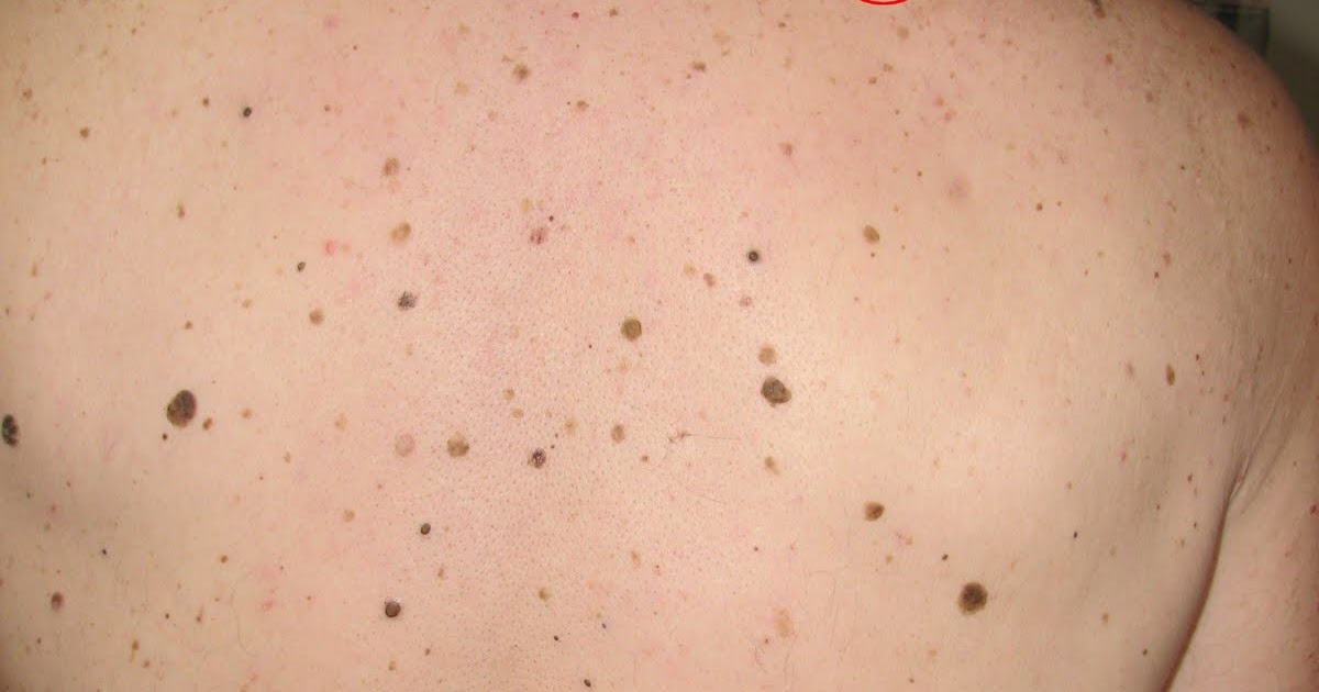 dermoscopy: Lost among black benign lesions....