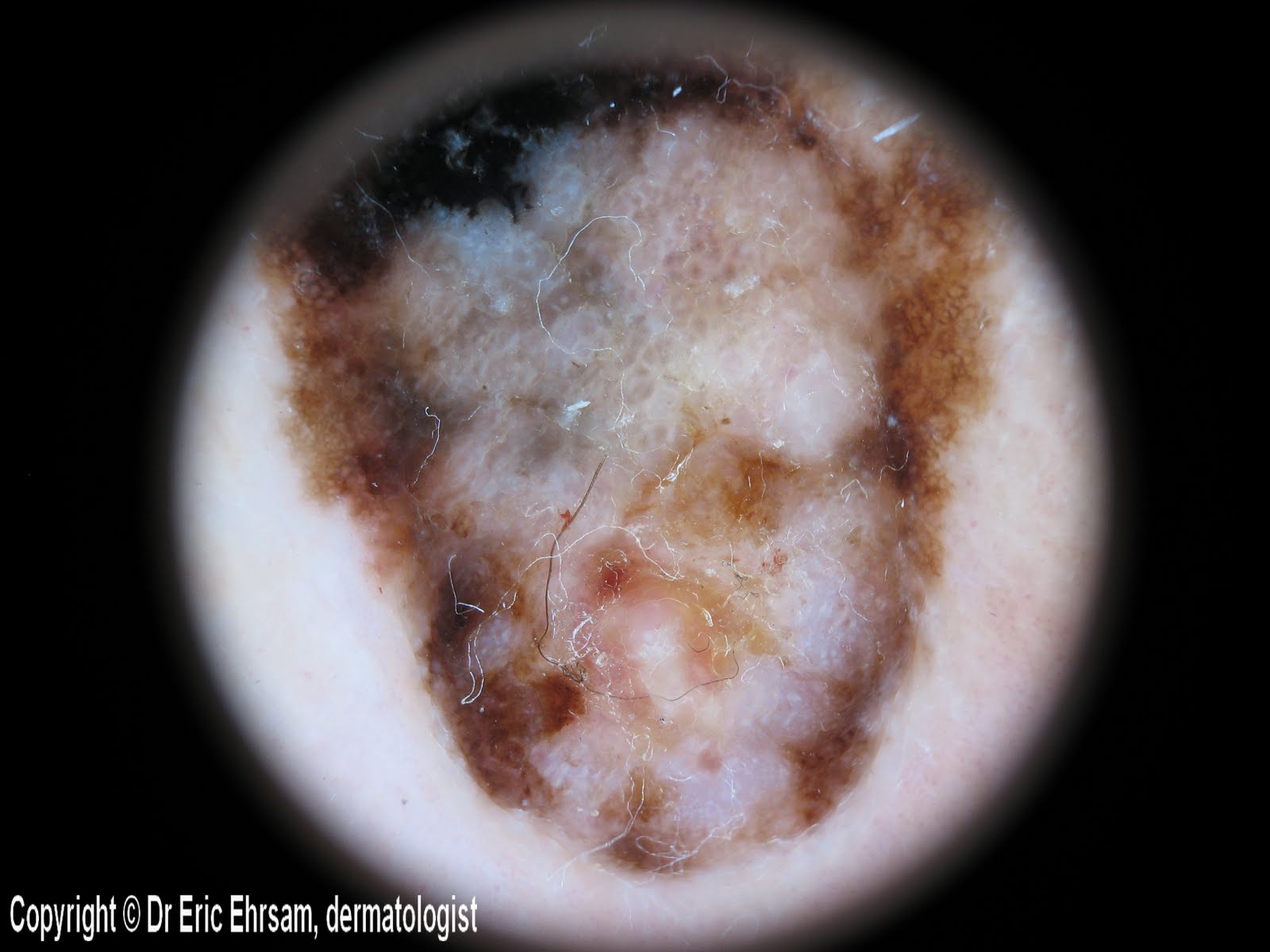 dermoscopy: What is this lesion on a leg (2nd case)