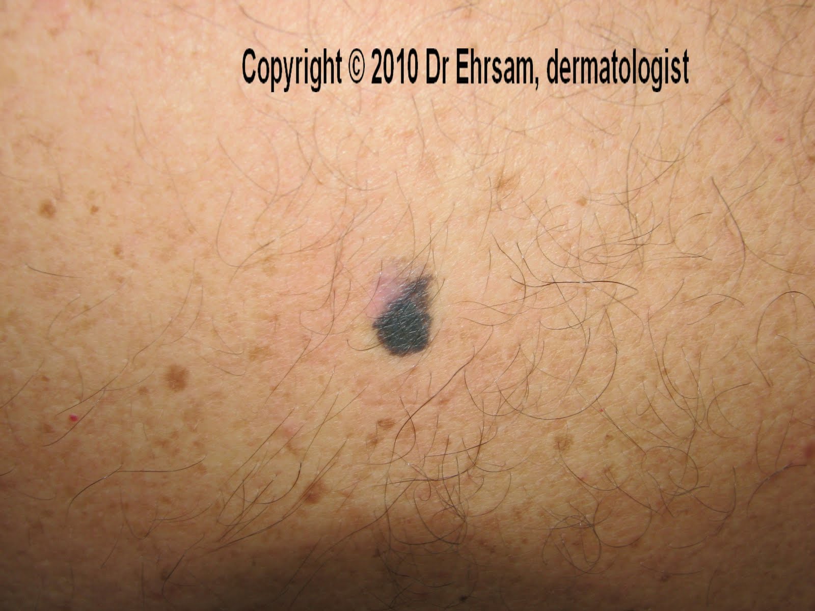 dermoscopy: October 2010